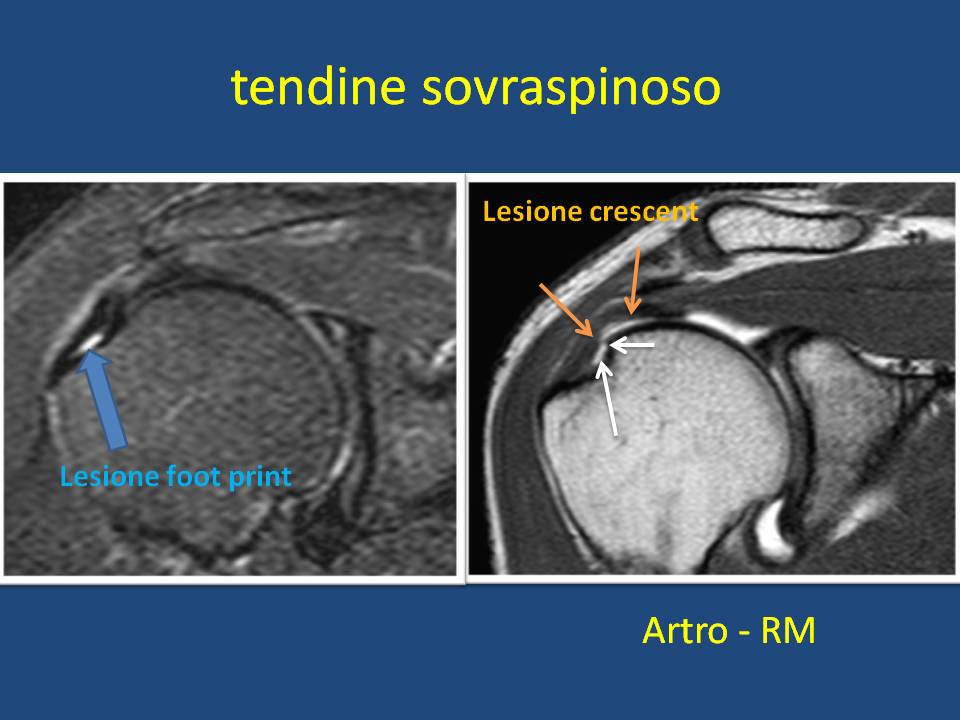 Le Lesioni Parziali Del Sovraspinoso Radiologia Ortopedica